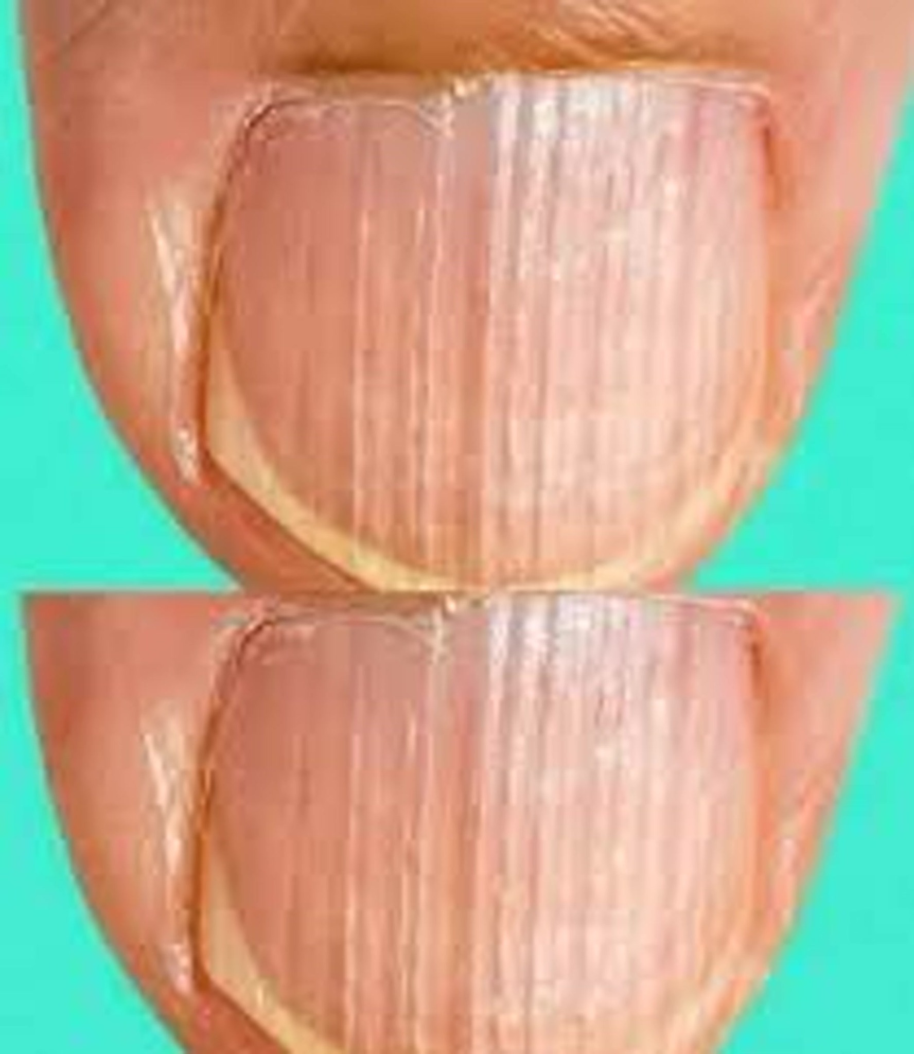 Having Striped Nails Could Mean That Your Body is….Read more – USA